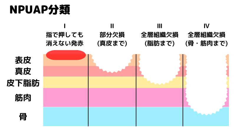 NPUAP分類 覚え方 語呂合わせ｜＊看護国試ゴロ＊看護師国家試験対策 絶対合格するぞ！